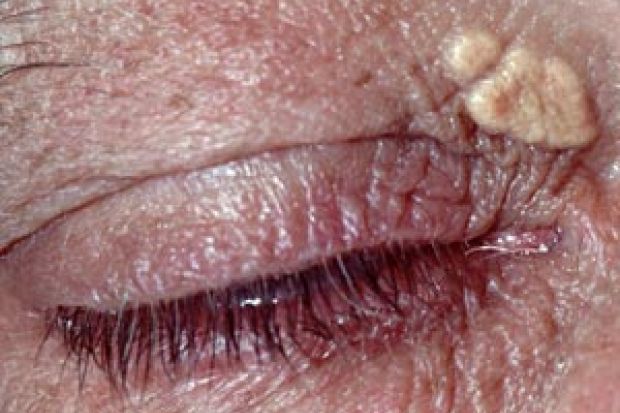 Xanthelasma Causes