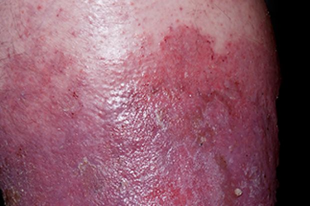Test your knowledge of cellulitis | Chemist+Druggist