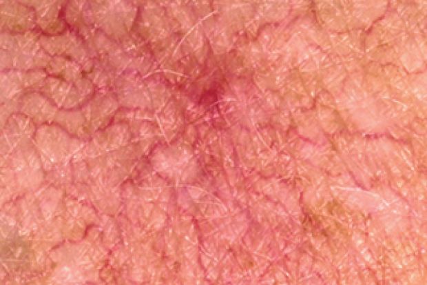 Talking telangiectasia | Chemist+Druggist