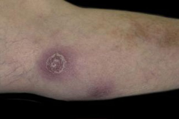 Panniculitis | Chemist+Druggist